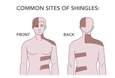 Shingles - Articles | Dis-Chem